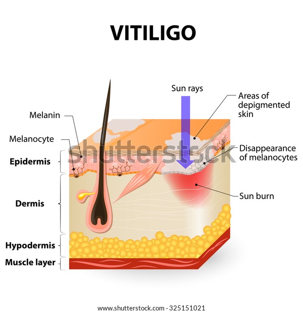 Vitiligo Skin Condition Characterized By Portions Stock Vector (Royalty ...