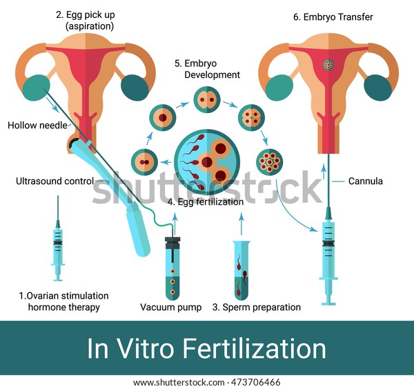 Vitro Fertilization Infographic Chart Flat Style Stock Vector (Royalty ...