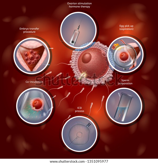 Vitro Fertilization Infographics Fertilizing Process By Stok Vektör ...