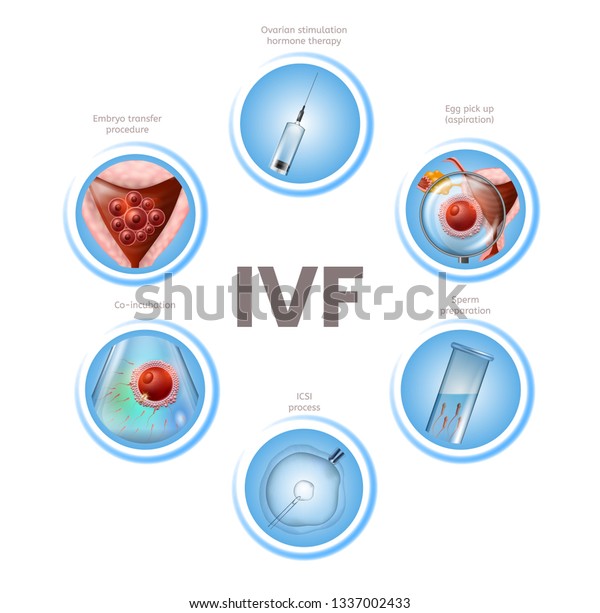 Vitro Fertilization Infographics Labeled Round Icons Stok Vektör ...