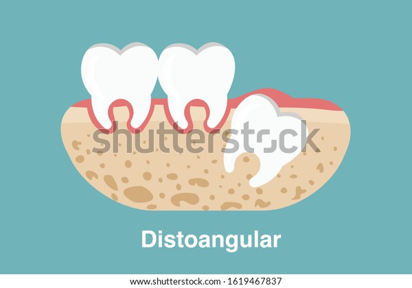 Wisdom Tooth Distoangular Impaction Illustration Vector Stock Vector 0460