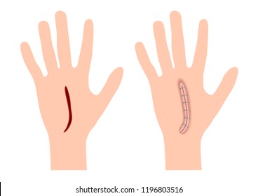 Bleeding Wrist Drawing