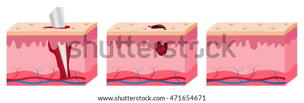 Wound Skin Vector Graphic 3 Stages: стоковая векторная графика (без ...