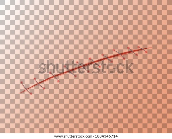 Wound Suturing On Transparent Background Illustration 库存矢量图（免版税 ...