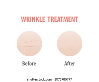 Wrinkle Treatment Comparison Illustration Vector On Stock Vector ...