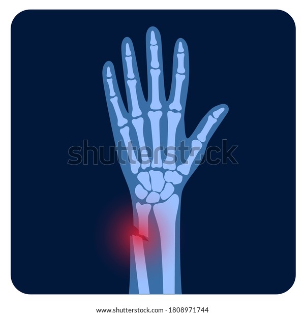 X Ray Arm Fracture Red Pain 库存矢量图（免版税）1808971744 | Shutterstock