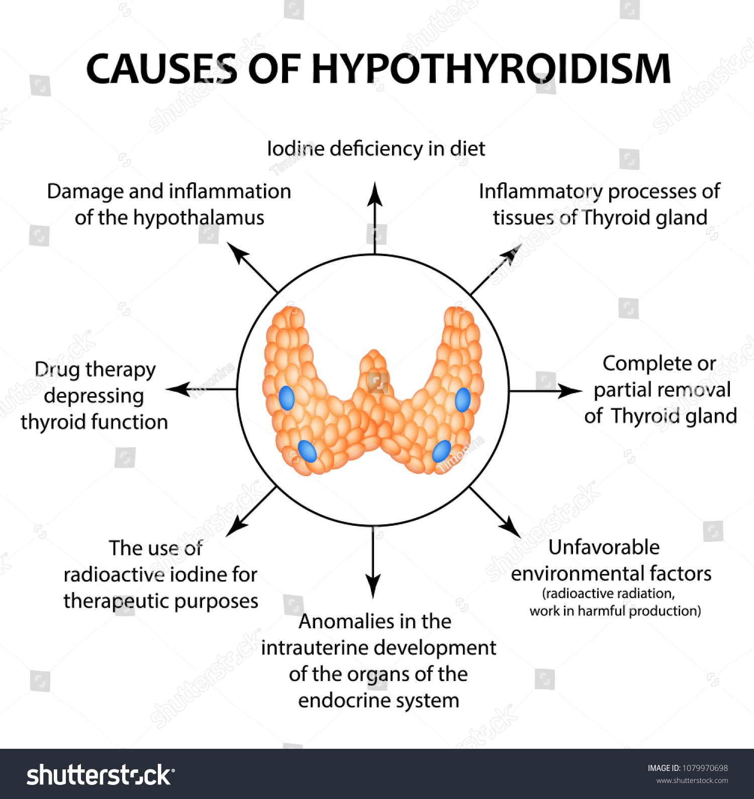 Causes Thyroid Hypothyroidism Infographics Vector Illustration Stock