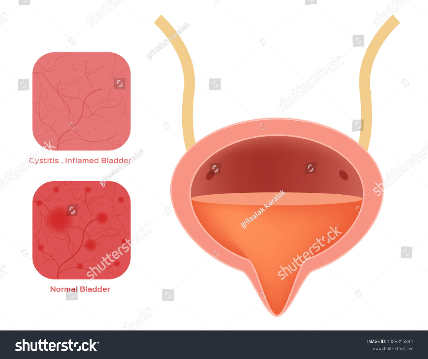 Cystitis On Bladder Vector Infection Inflammation Stock Vector Royalty