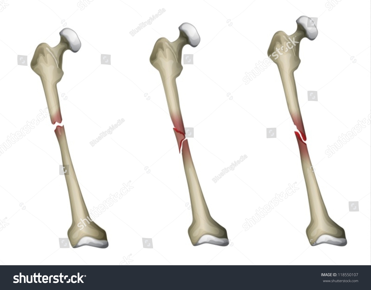 Three Types Bone Fracture Femur 库存矢量图(免版税)118550107 Shutterstock