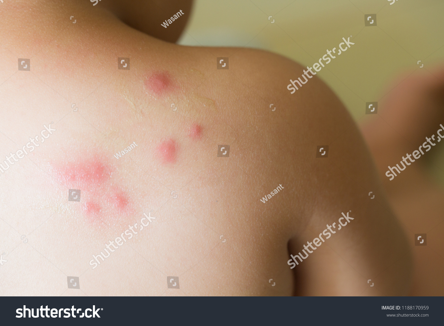 Skin Rash Blisters On Body Foto Stok 1188170959 Shutterstock