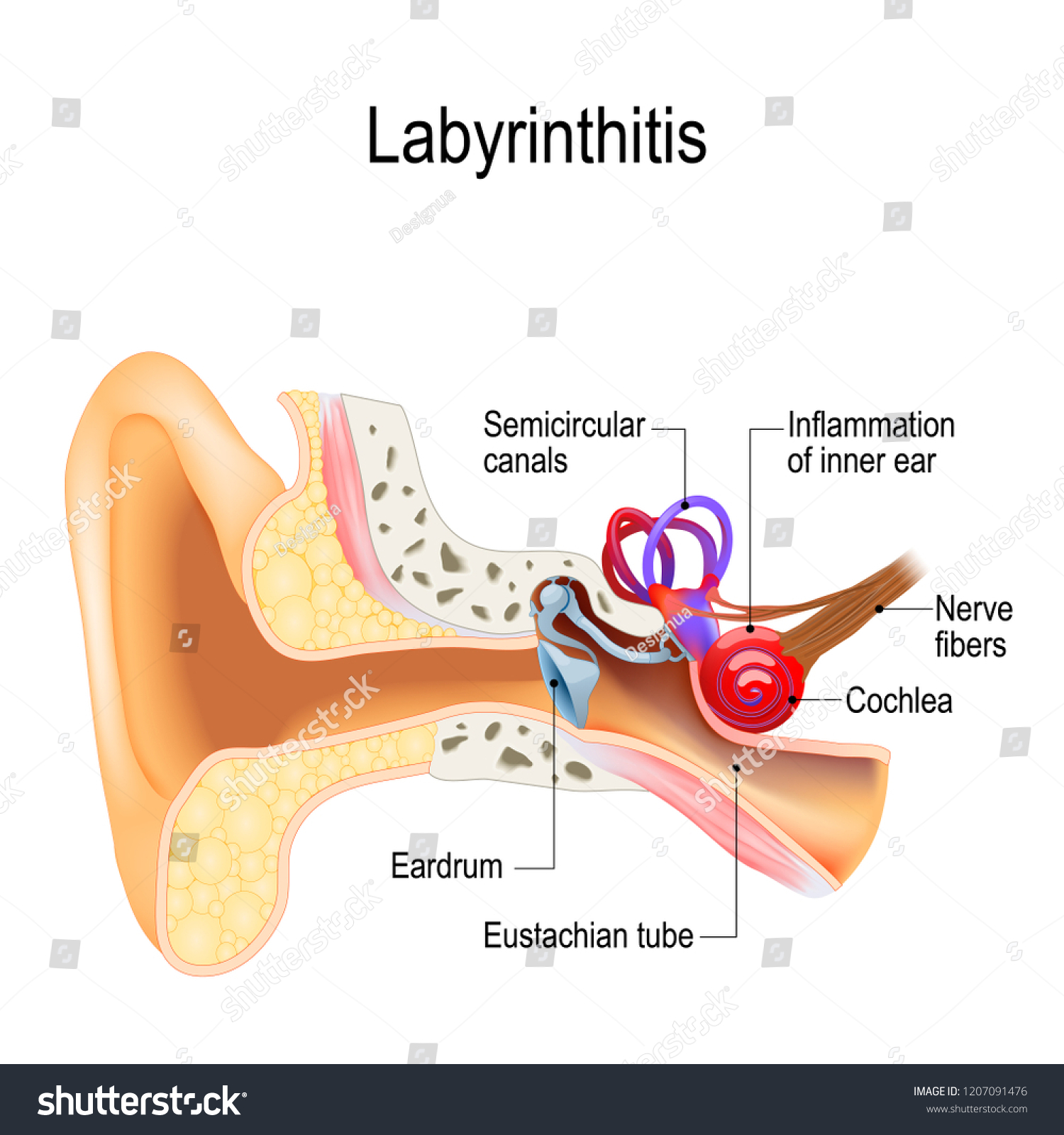 Labyrinthitis Vestibular Neuritis Inflammation Inner Ear: ภาพประกอบ ... Labyrinthitis Vestibular Neuritis Inflammation Inner Ear: ภาพประกอบ ...