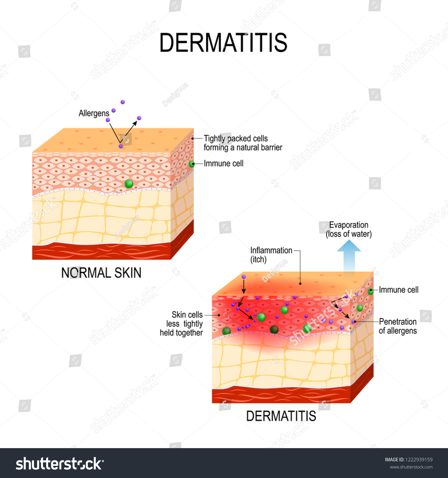 Atopic Dermatitis Atopic Eczema Healthy Skin Stock Illustration 1222939159 Shutterstock