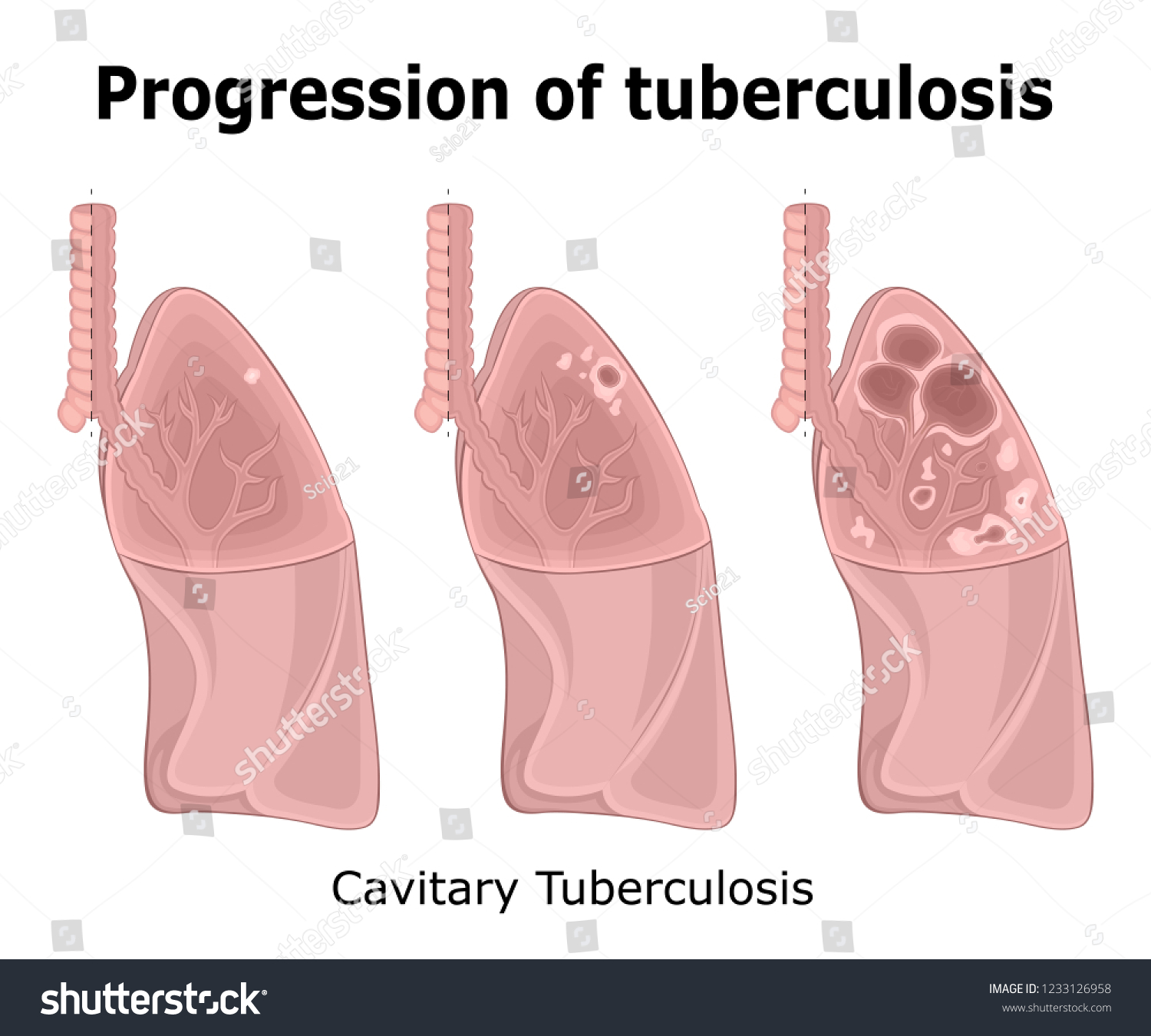 Illustration Progression Cavitary Pulmonary Tuberculosis 库存矢量图(免版税