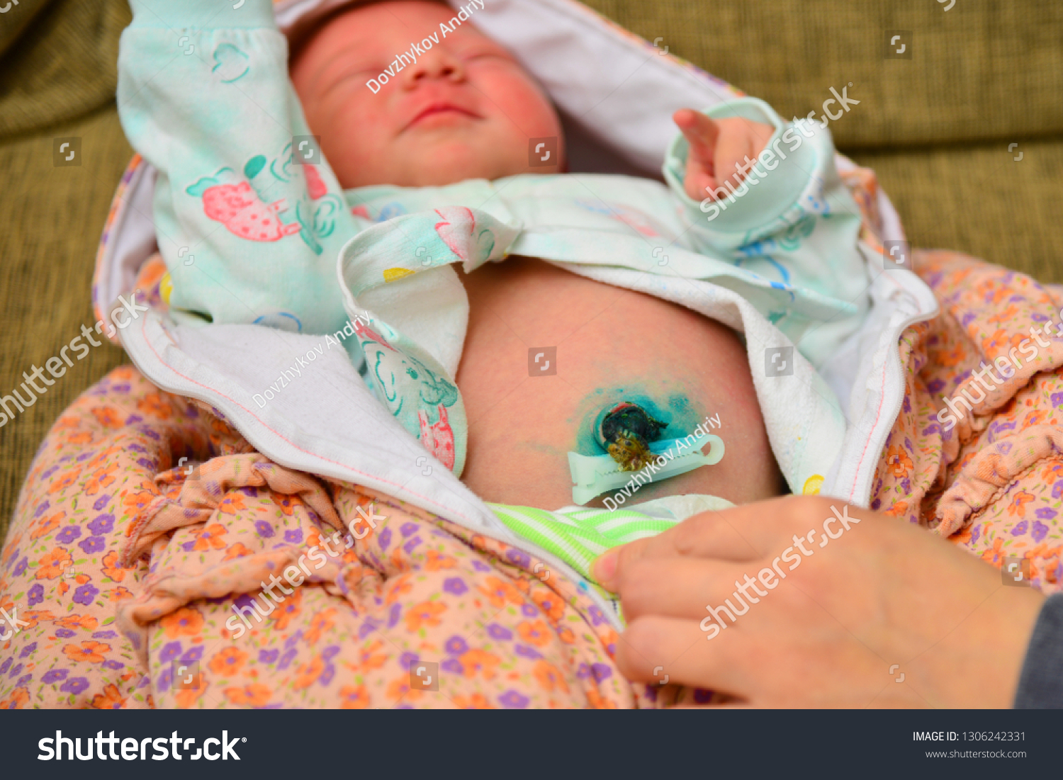 Newborn Baby Umbilical Cord Infection Treatment at Bethany Lindrum blog Newborn Baby Umbilical Cord Infection Treatment at Bethany Lindrum blog