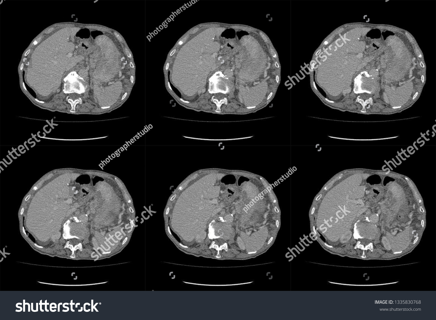 Ct Scan Computed Tomography Whole Abdomen Stock Photo 1335830768 ... Ct Scan Computed Tomography Whole Abdomen Stock Photo 1335830768 ...