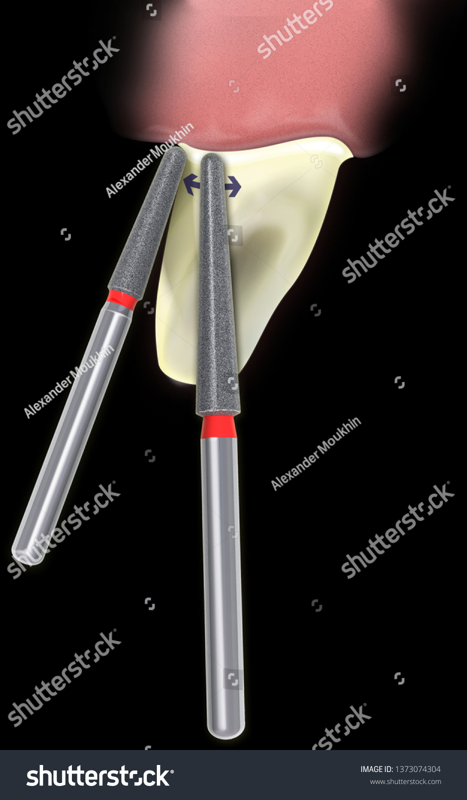 Preparing Shaping Tooth Diamond Dental Burs Stock Illustration ... Preparing Shaping Tooth Diamond Dental Burs Stock Illustration ...