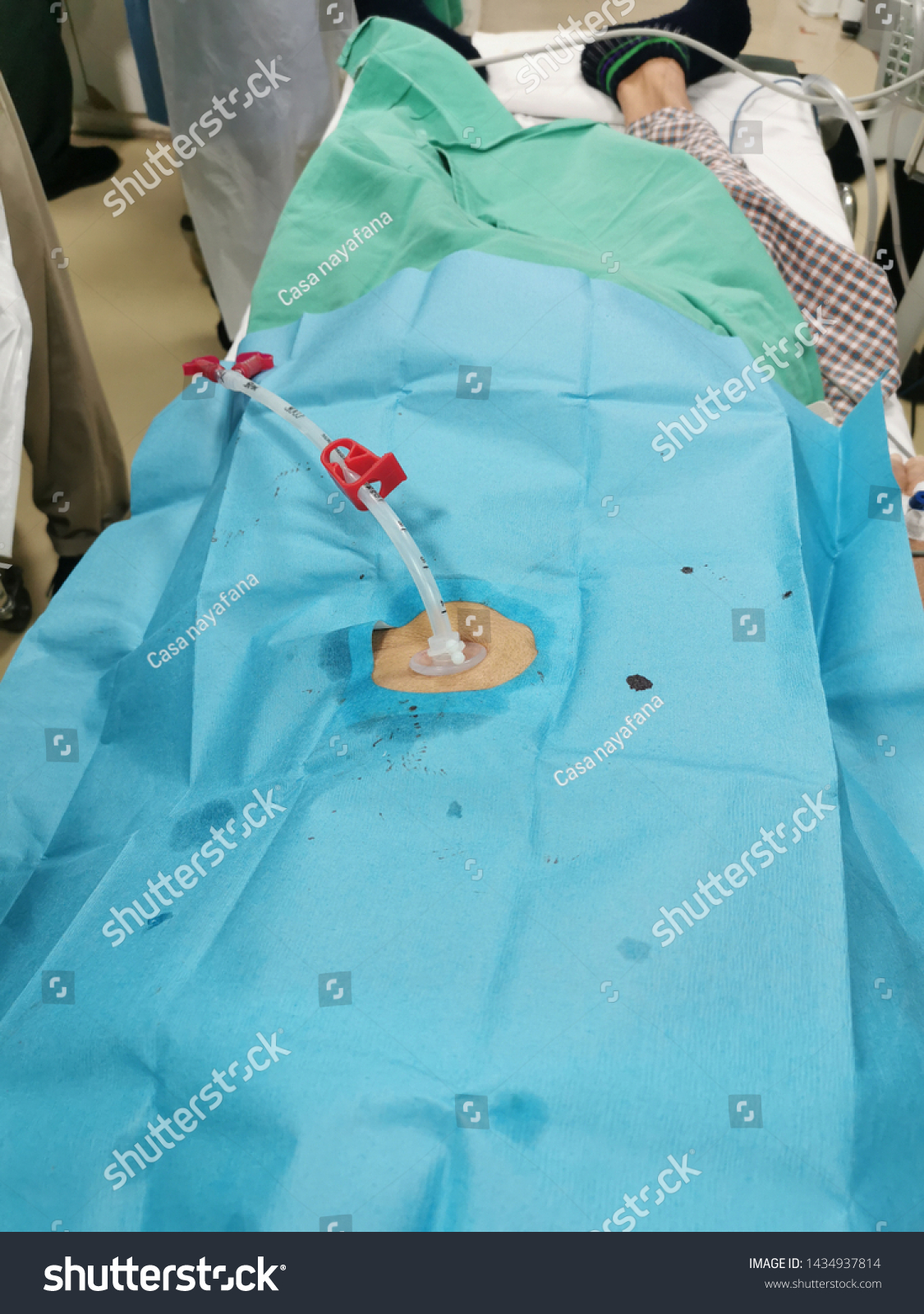Peg Tube Insertion Percutaneous Endoscopic Gastrostomy Stock Photo ... Peg Tube Insertion Percutaneous Endoscopic Gastrostomy Stock Photo ...