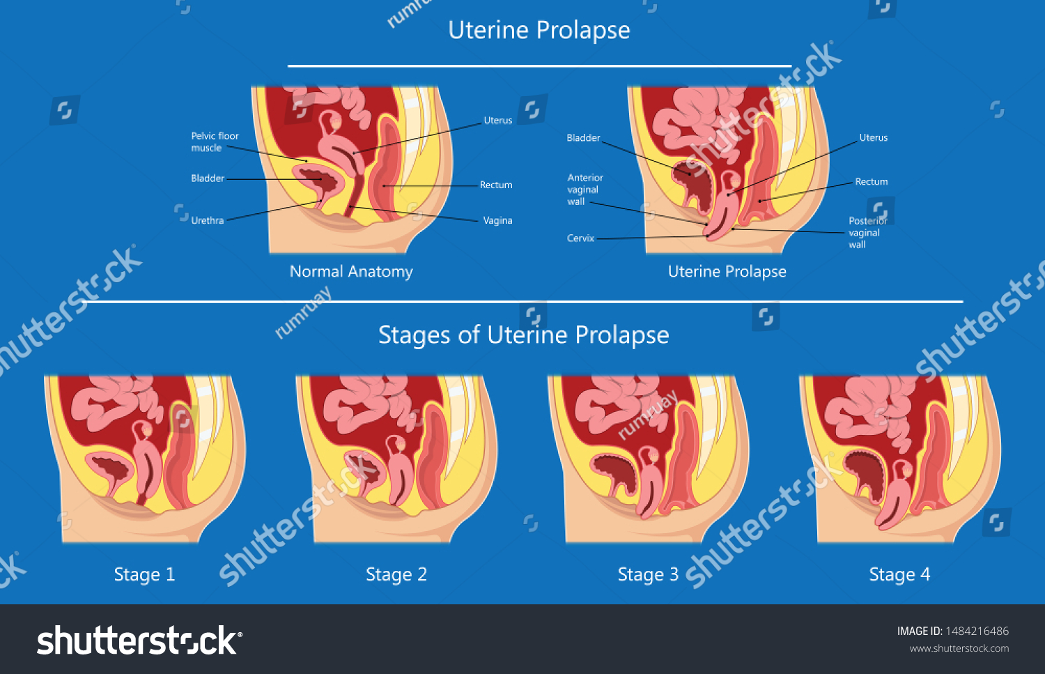 Vektor Stok Pelvic Floor Prolapse Type Uterine Uterus Tanpa Royalti