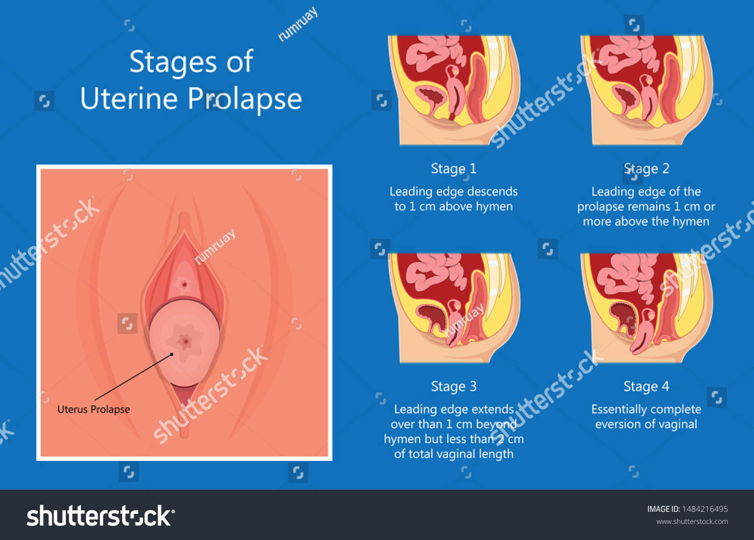 Pelvic Floor Prolapse Type Uterine Uterus Stock Vector Royalty Free
