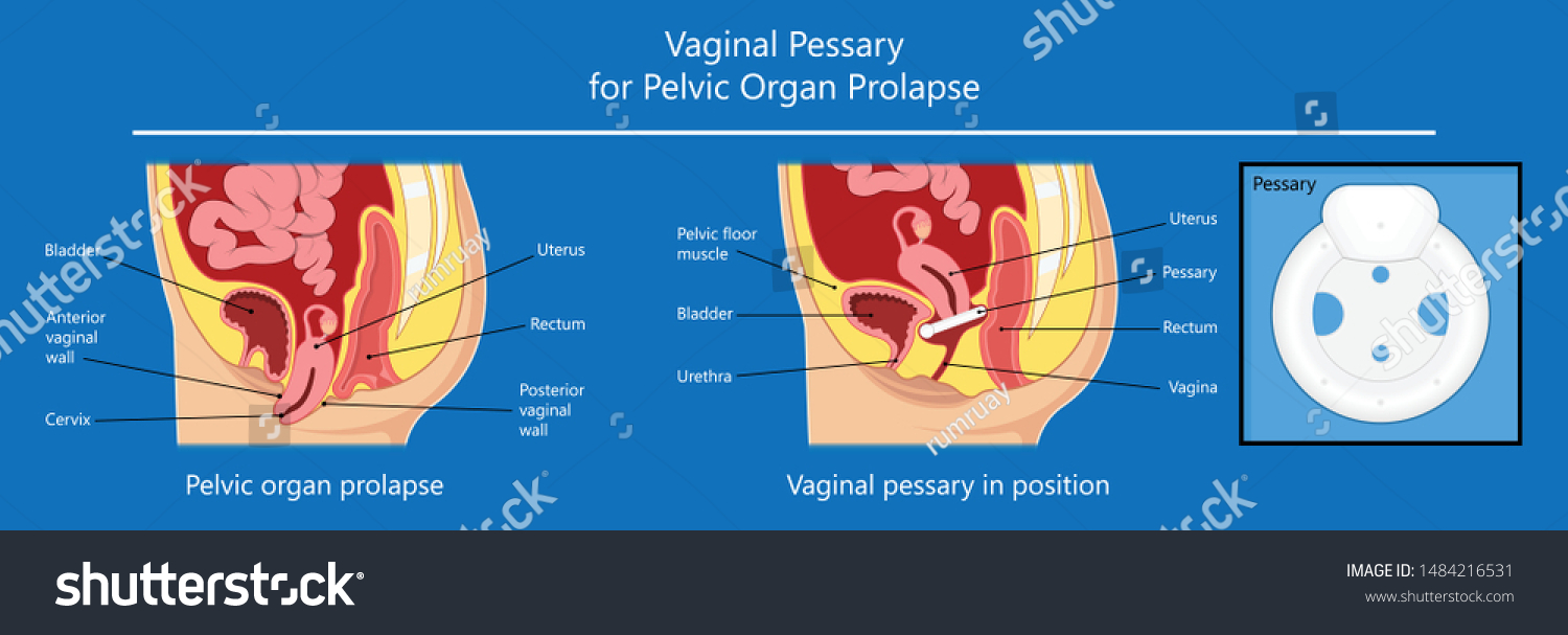 Pelvic Floor Prolapse Type Uterine Uterus Stock Vector Royalty Free