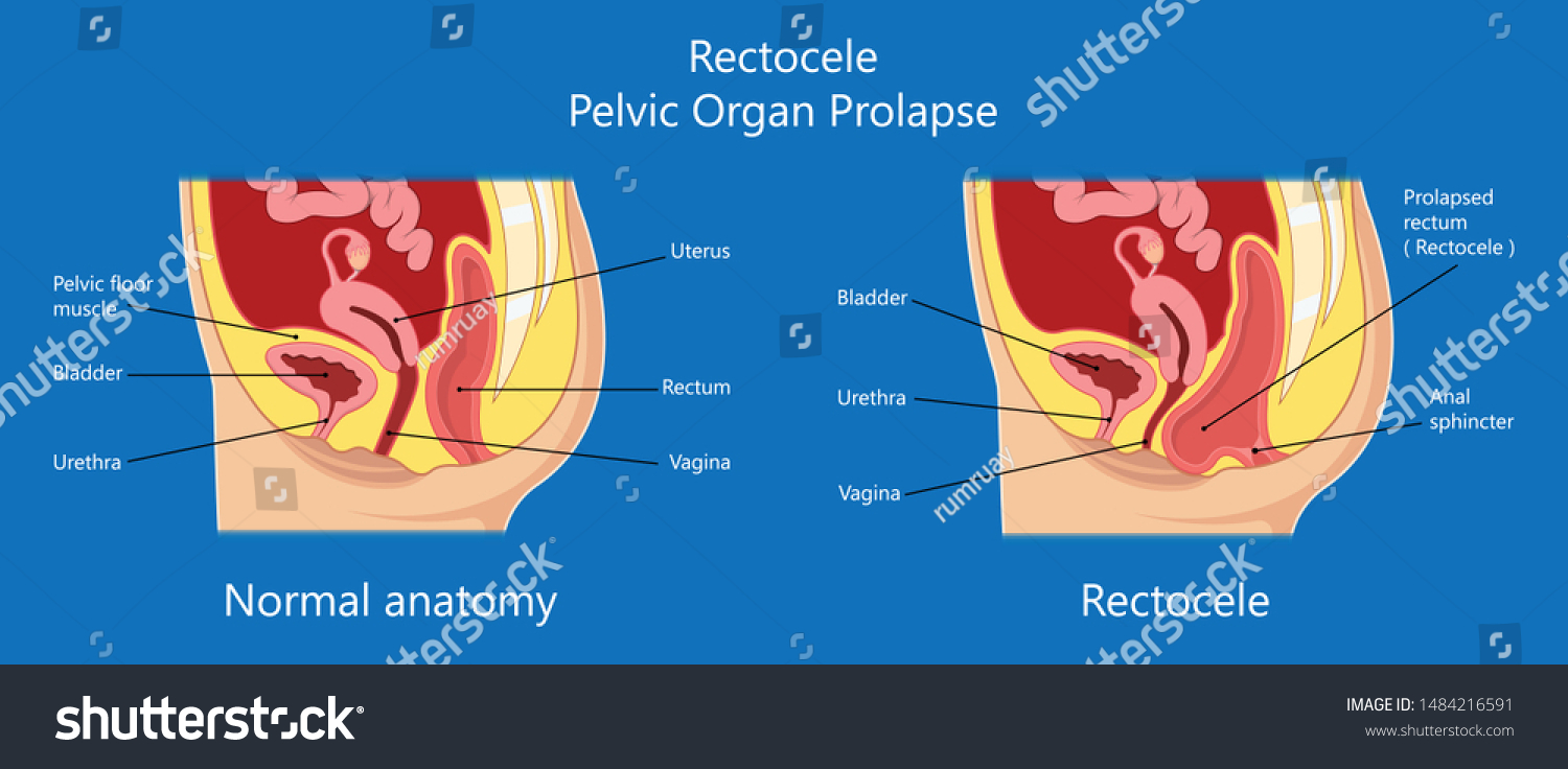 Pelvic Floor Prolapse Type Uterine Uterus Stock Vector Royalty Free