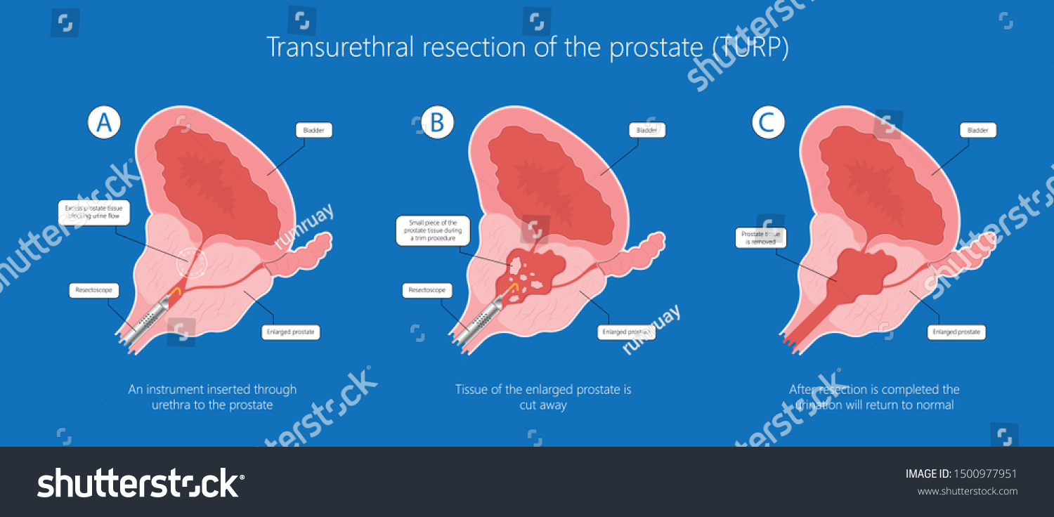 Transurethral Resection Prostate Stricture Urine Bladder Stock Vector