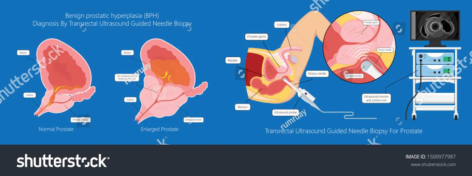 Transurethral Resection Prostate Stricture Urine Bladder Stock Vector