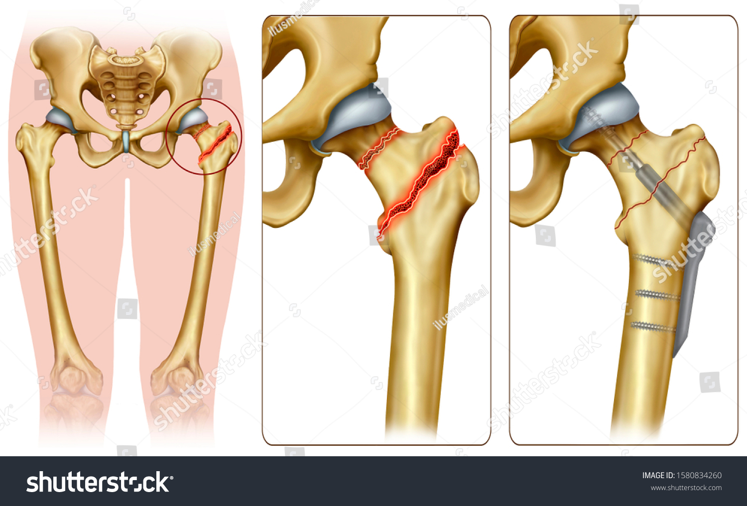 Illustration Fracture Femur Bone Fracture Femoral Stock Illustration 1580834260 Shutterstock