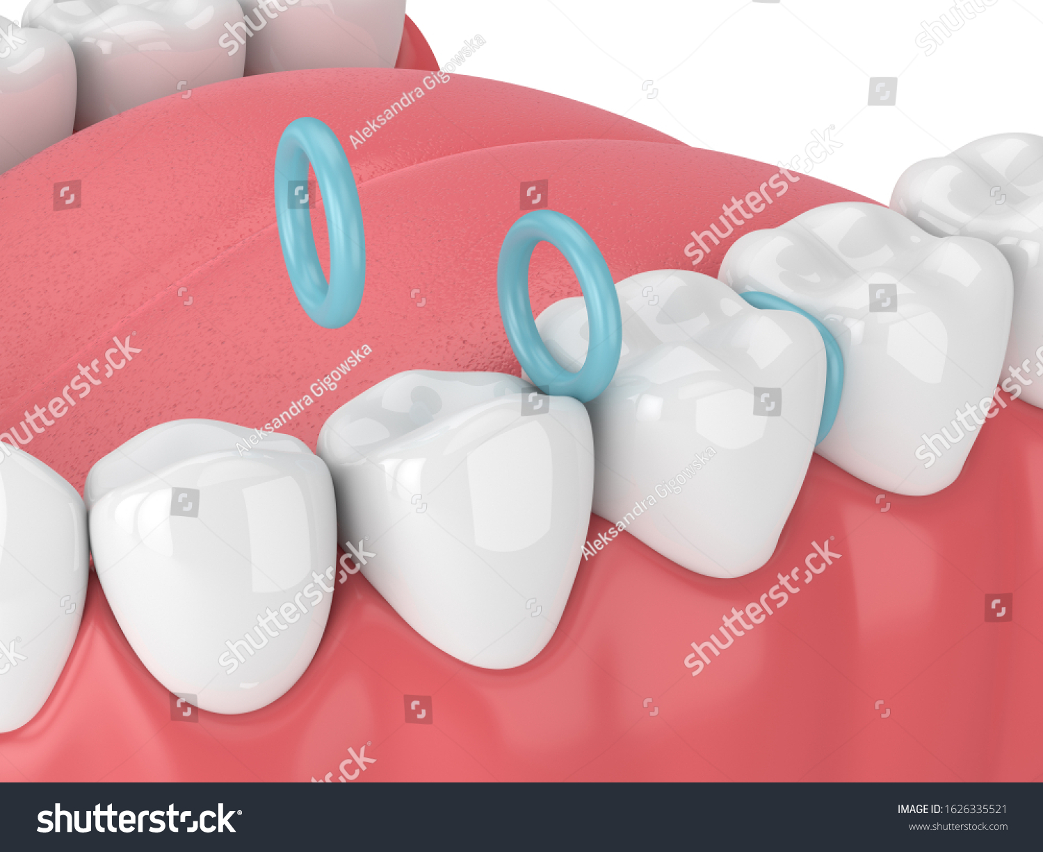 113 Separators orthodontic Images, Stock Photos & Vectors | Shutterstock 113 Separators orthodontic Images, Stock Photos & Vectors | Shutterstock