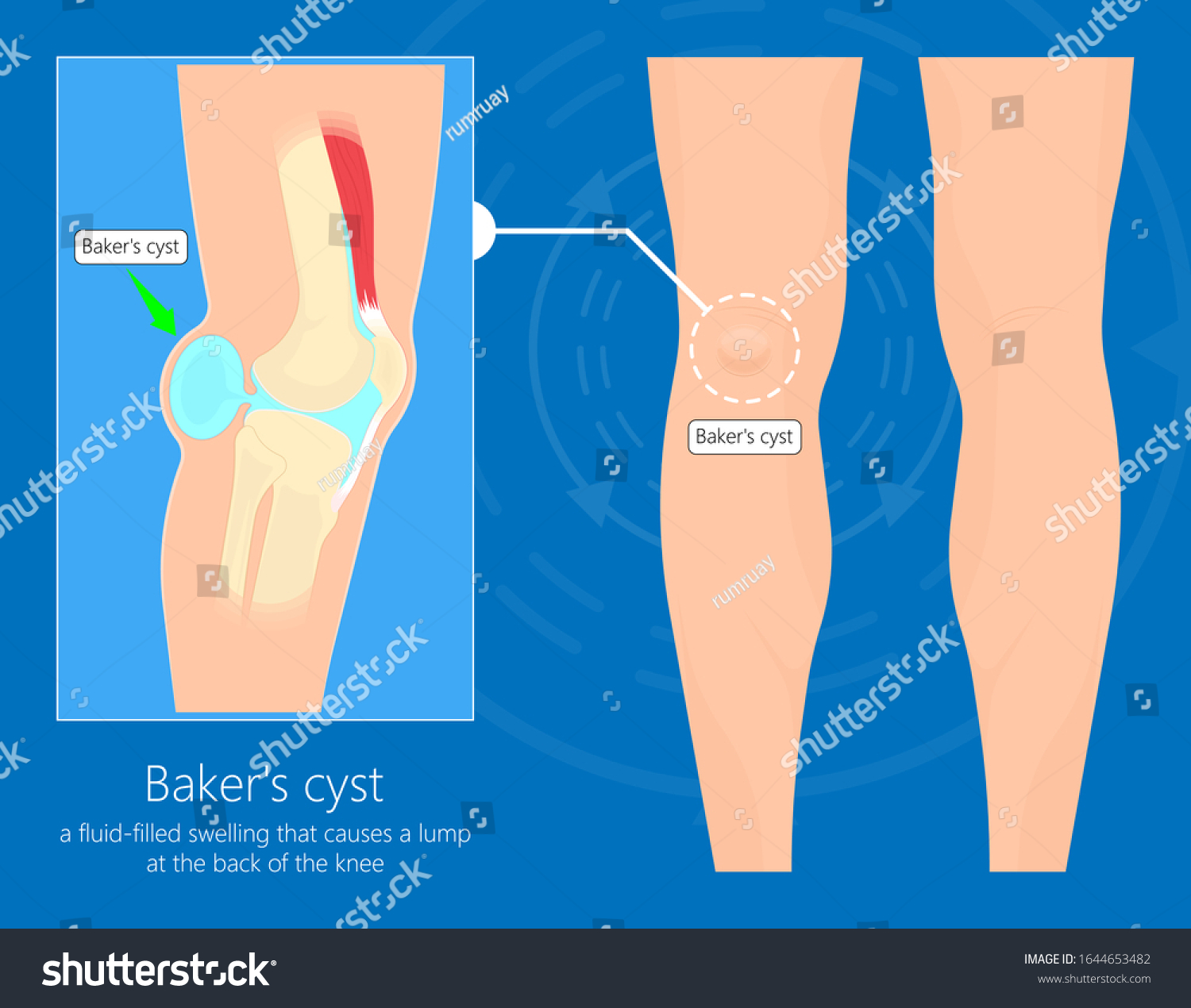 Bakers Cyst Popliteal Swelling Knee Joint Stockvector Rechtenvrij 1644653482 Shutterstock