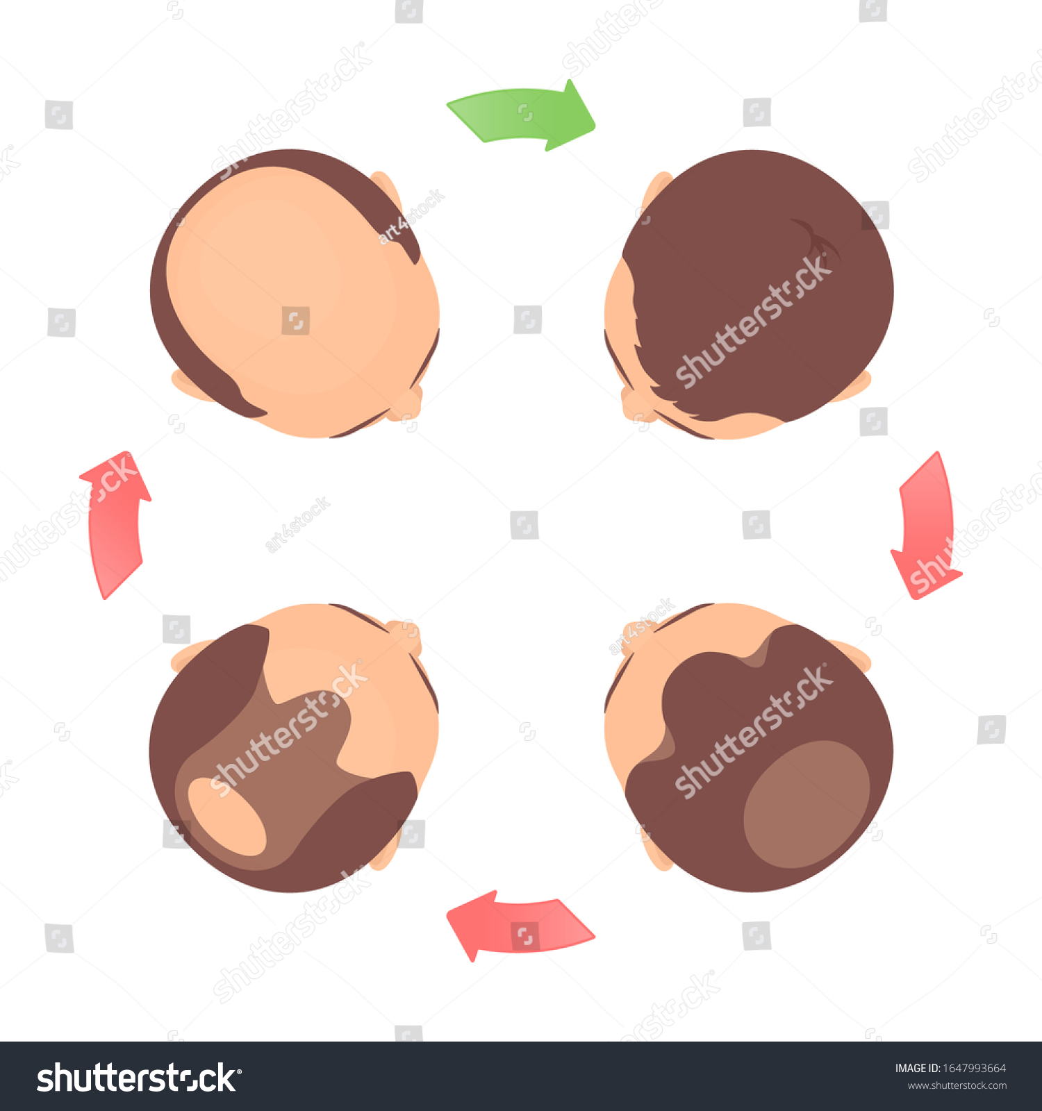Malepattern Hair Loss 4 Stages Set Stock Vector Royalty Free