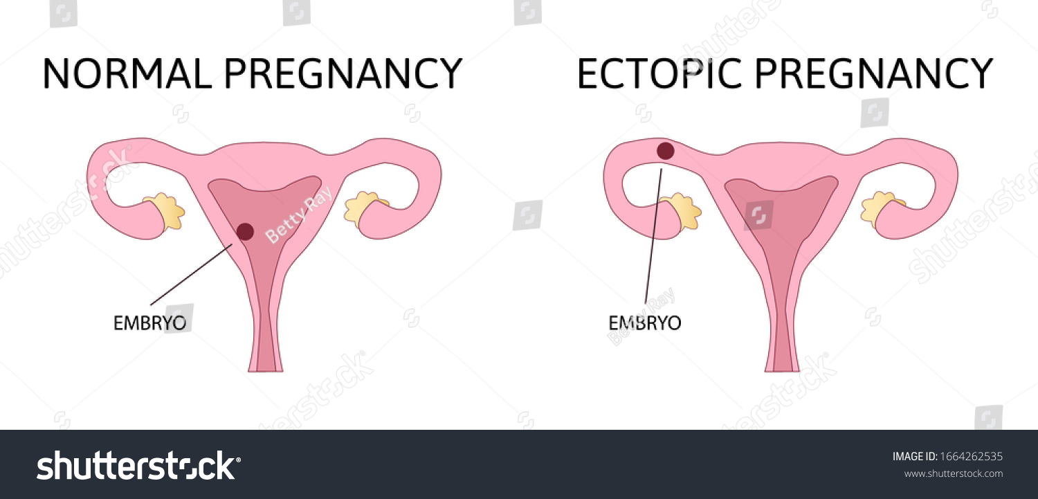 Ectopic Normal Pregnancy Fertilized Egg Uterus Stock Vector Royalty Free 1664262535 Shutterstock