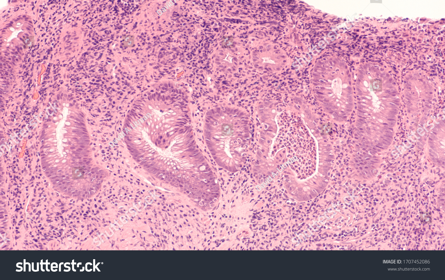 Photomicrograph Colon Biopsy Obtained During Colonoscopy Stock Photo ... Photomicrograph Colon Biopsy Obtained During Colonoscopy Stock Photo ...