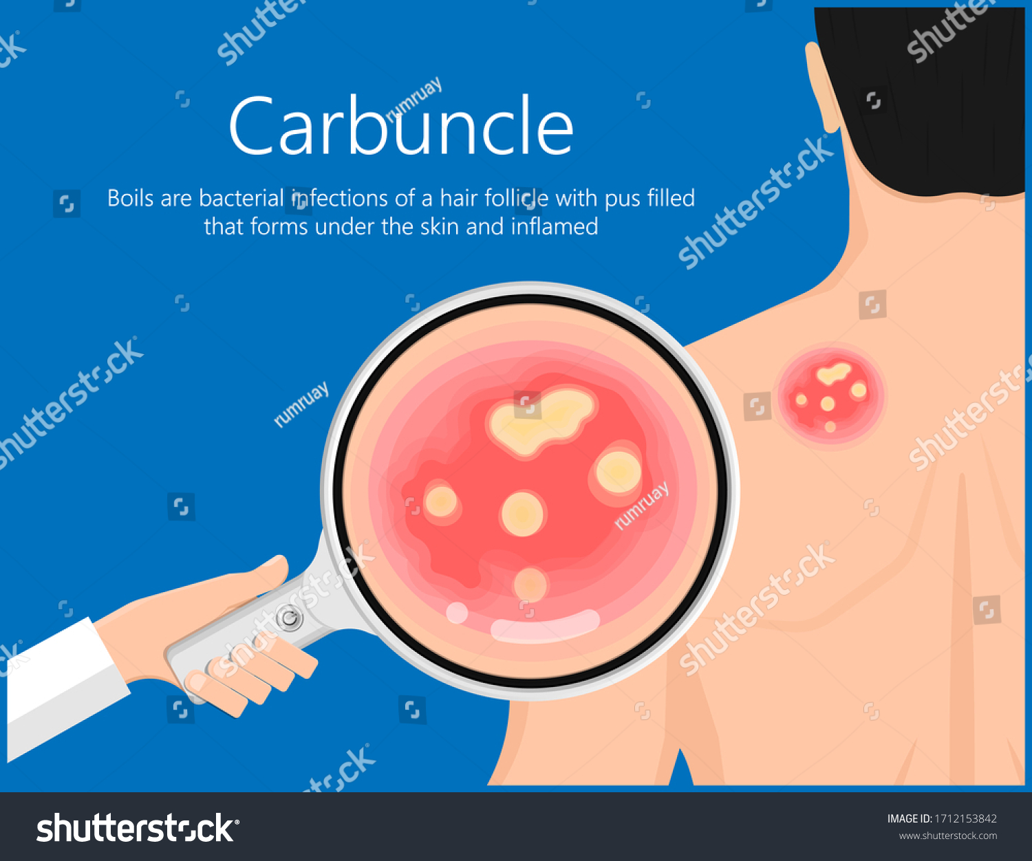 Carbuncle Boils Bacterial Infection Under Skin Stock Vector Royalty Free 1712153842 Shutterstock