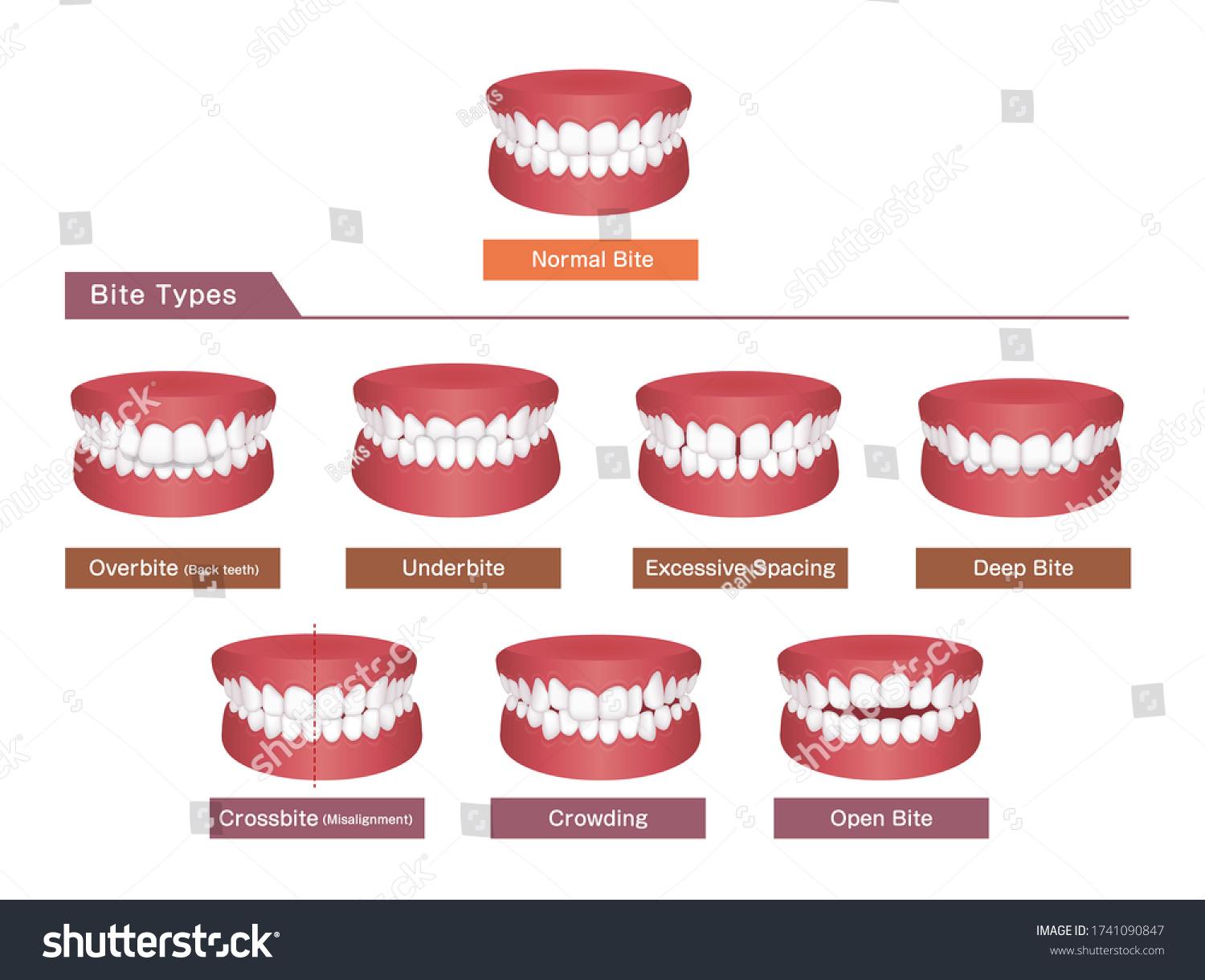 5 191 Imágenes De Orthodontic Problems Imágenes Fotos Y Vectores De