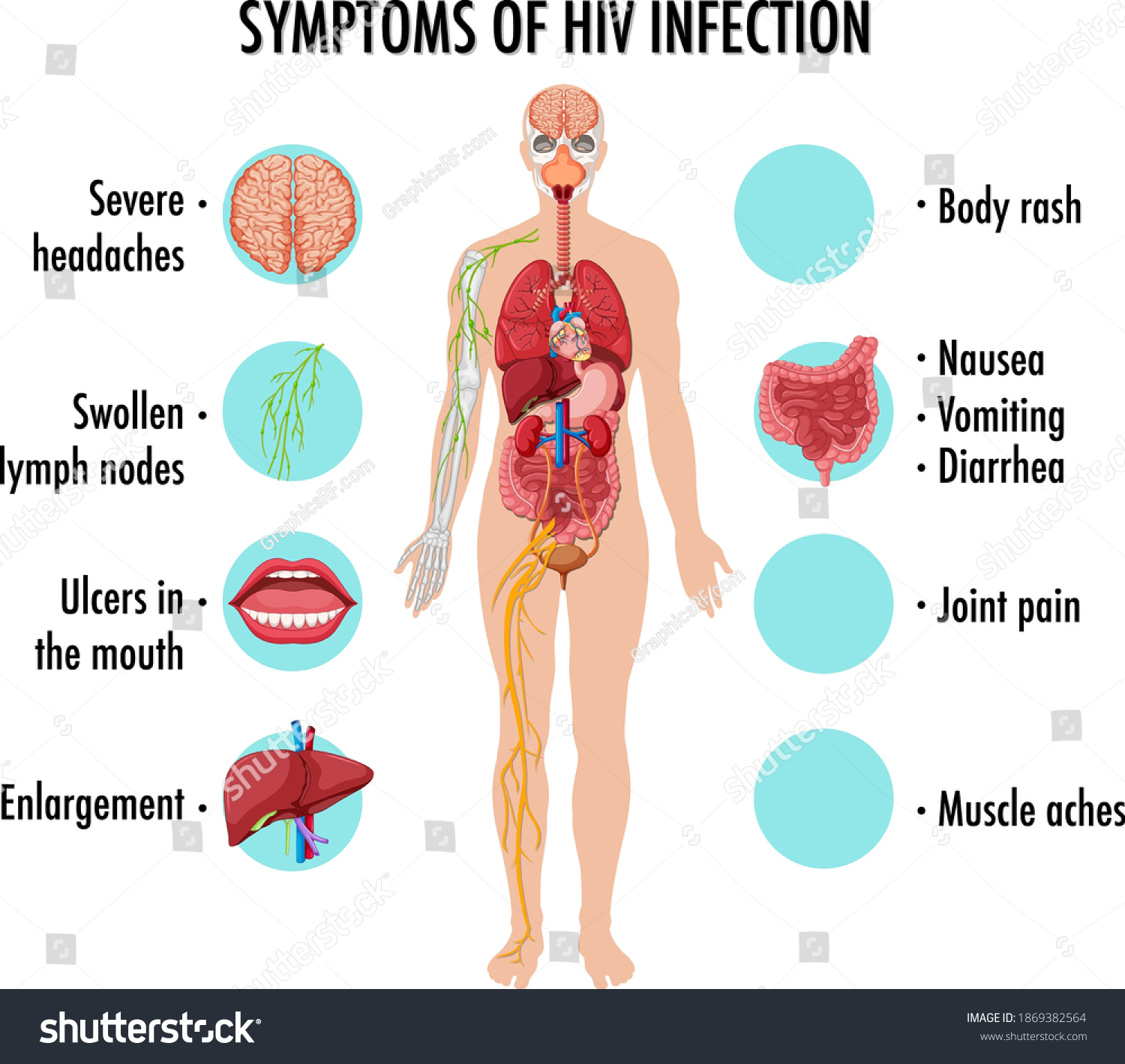 Symptoms Hiv Infection Infographic Illustration Stock Vector Royalty