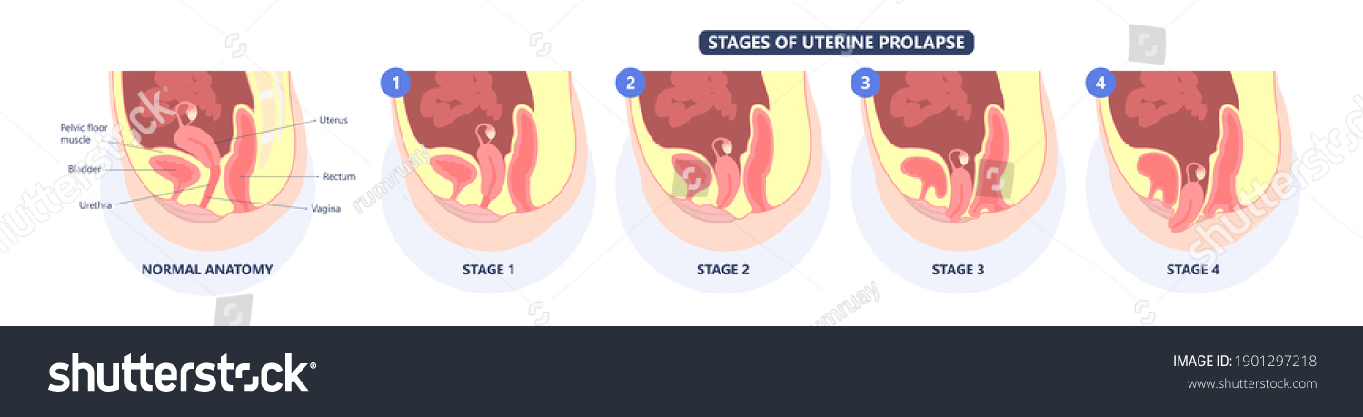 Pelvic Floor Prolapse Type Uterine Uterus Stock Vector Royalty Free