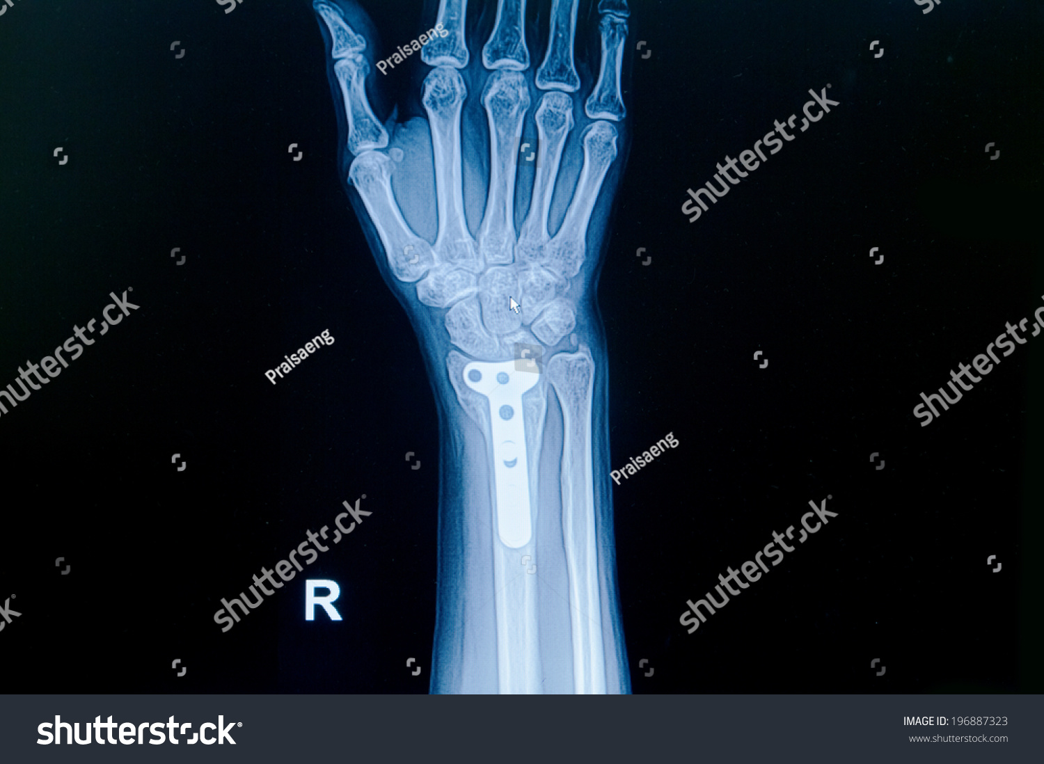 Film Xray Wrist Fracture Show Fracture Stock Photo 196887323 | Shutterstock Film Xray Wrist Fracture Show Fracture Stock Photo 196887323 | Shutterstock