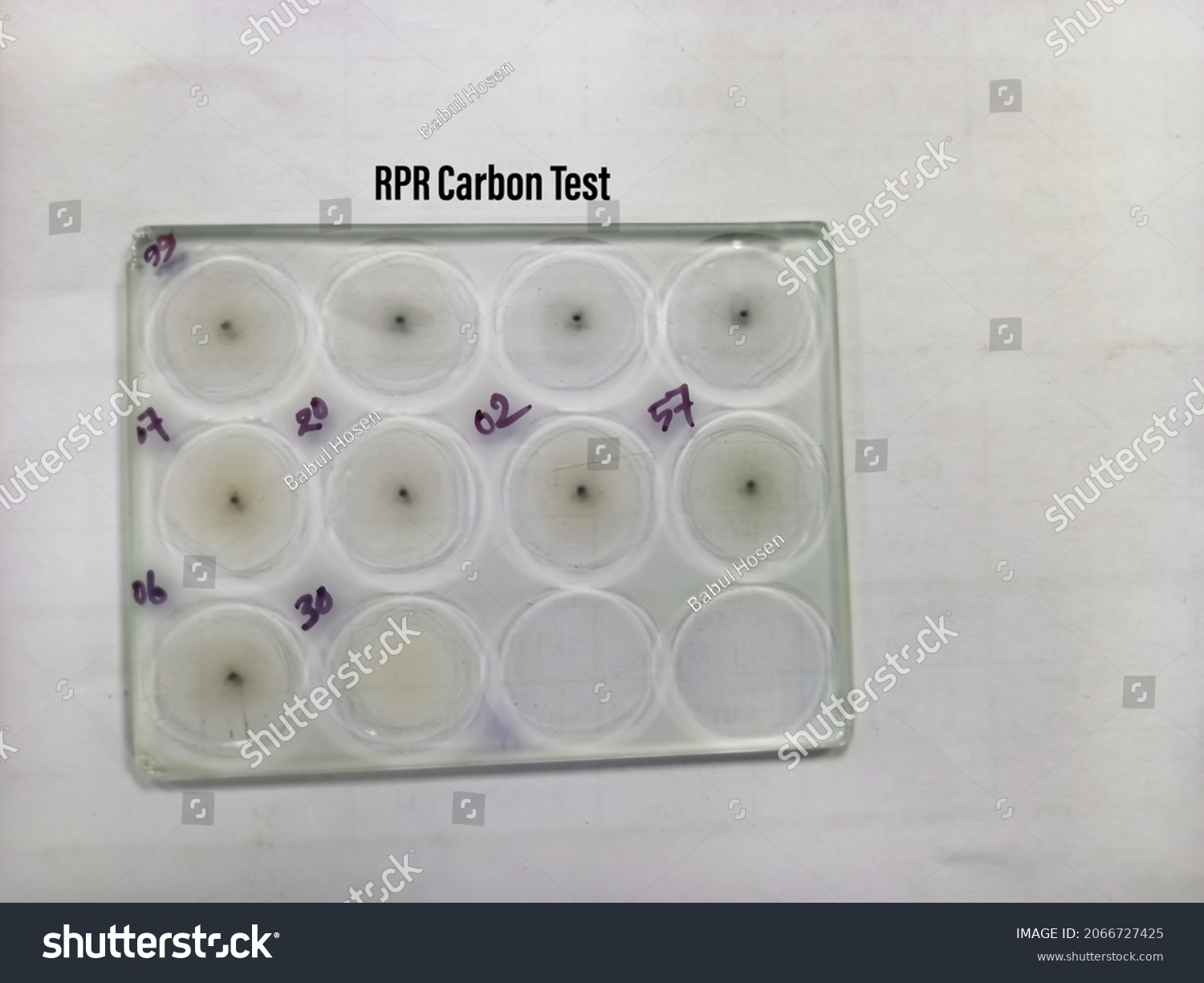 Rpr Vdrl Método De Aglutinación Por Foto De Stock 2066727425 Shutterstock