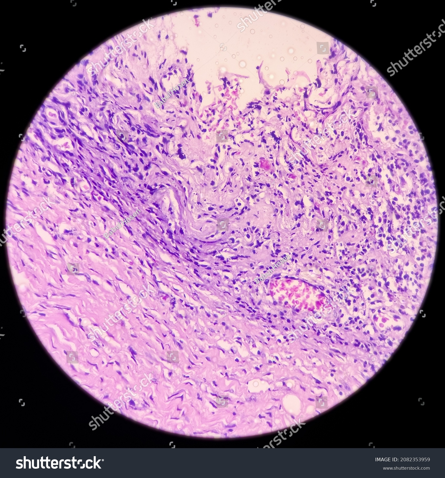 Región Perianal Con Tracto Fístula Inflamación Foto De Stock 2082353959 Shutterstock