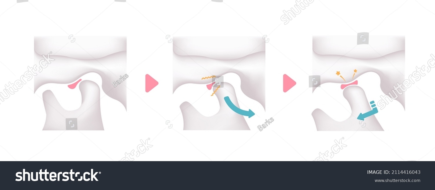 Illustration Cause Temporomandibular Disorders Tmd 库存矢量图(免版税)2114416043