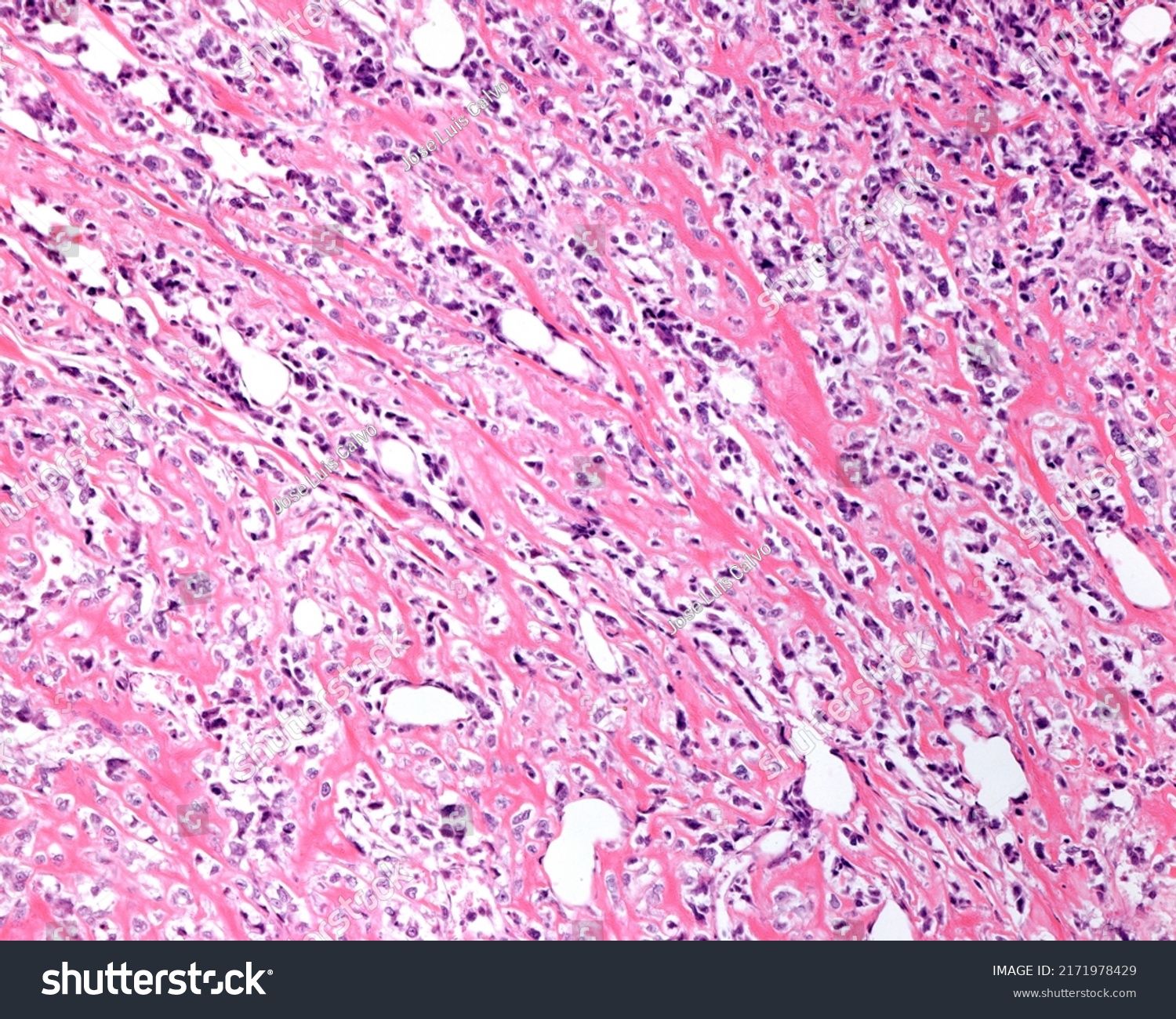 Osteogenic Sarcoma Light Microscope Micrograph Showing Stock Photo ... Osteogenic Sarcoma Light Microscope Micrograph Showing Stock Photo ...