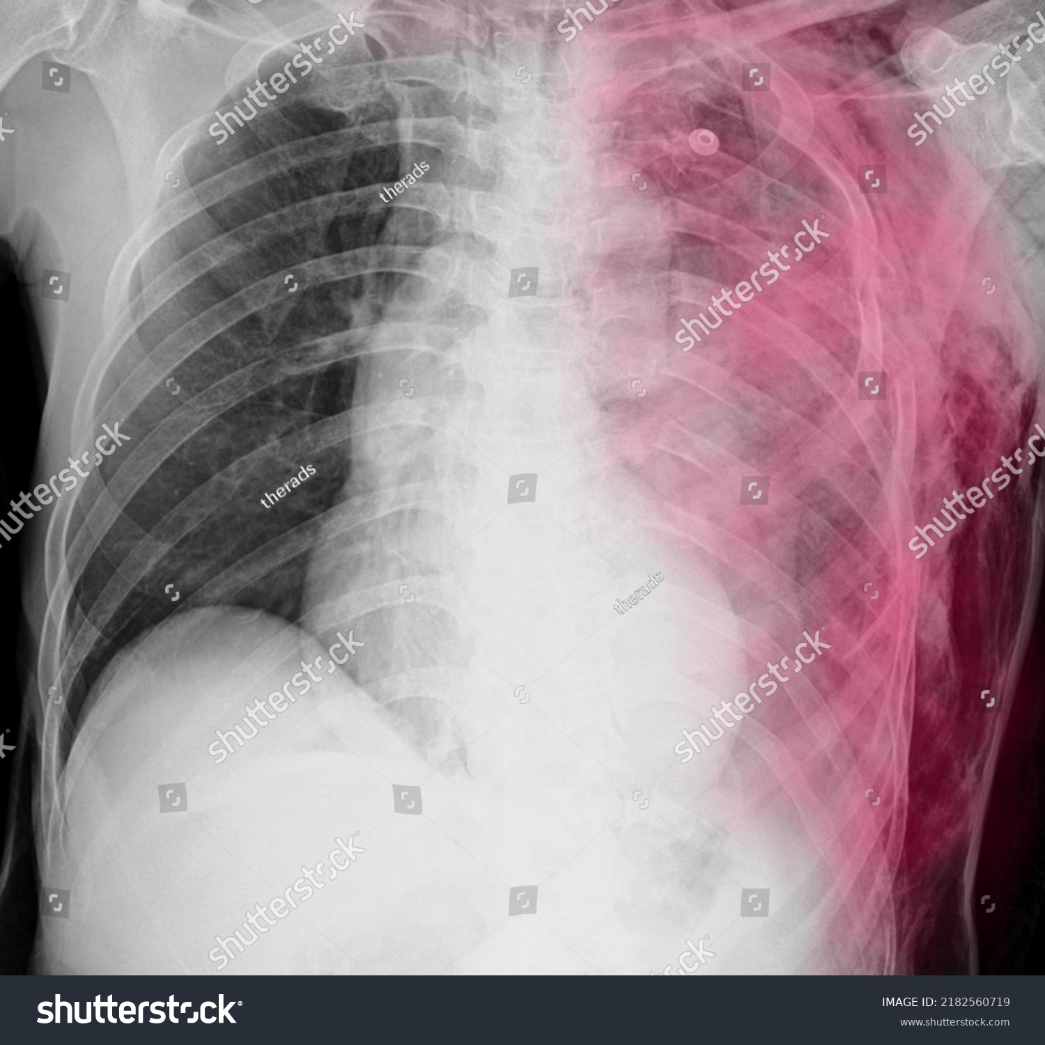 Ubcutaneous Emphysema Chest X Ray Subcutaneous Foto Stok 2182560719 ... Ubcutaneous Emphysema Chest X Ray Subcutaneous Foto Stok 2182560719 ...
