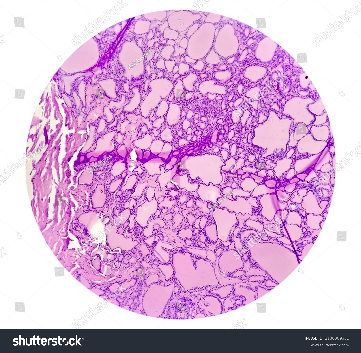 Scapula Cancer Synovial Sarcoma Monophasic Show Stock Photo 2186809631 ... Scapula Cancer Synovial Sarcoma Monophasic Show Stock Photo 2186809631 ...