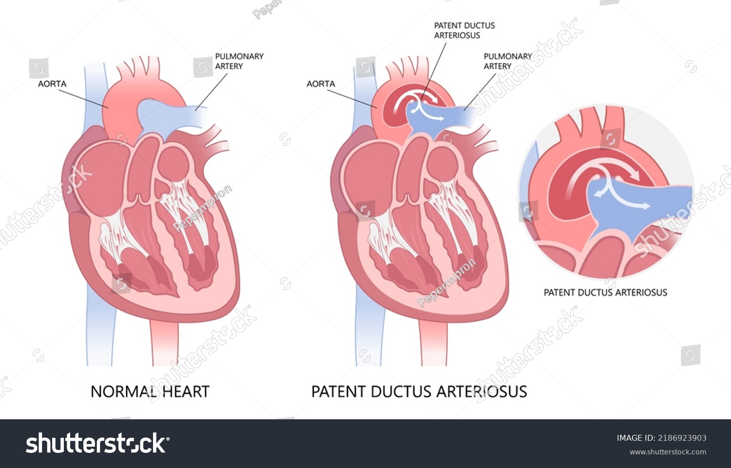Compared Between Normal Heart Patent Ductus Stock Vector Royalty Free