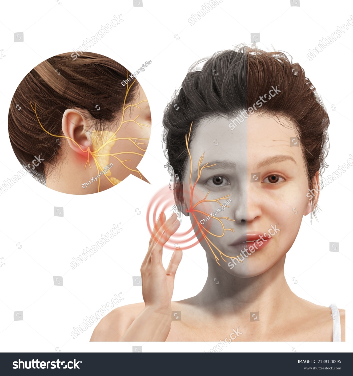 3d Medical Illustration Explain Facial Palsy Stock Illustration ... 3d Medical Illustration Explain Facial Palsy Stock Illustration ...