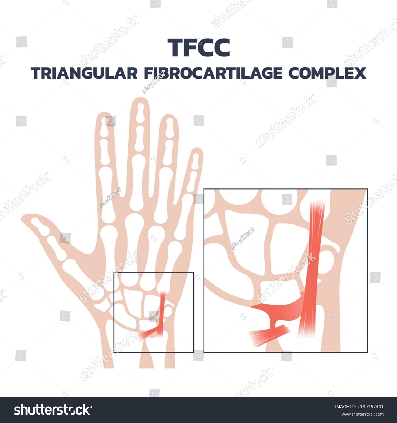 Anatomy Triangular Fibrocartilage Complex Tfcc Wrist Stock Vector
