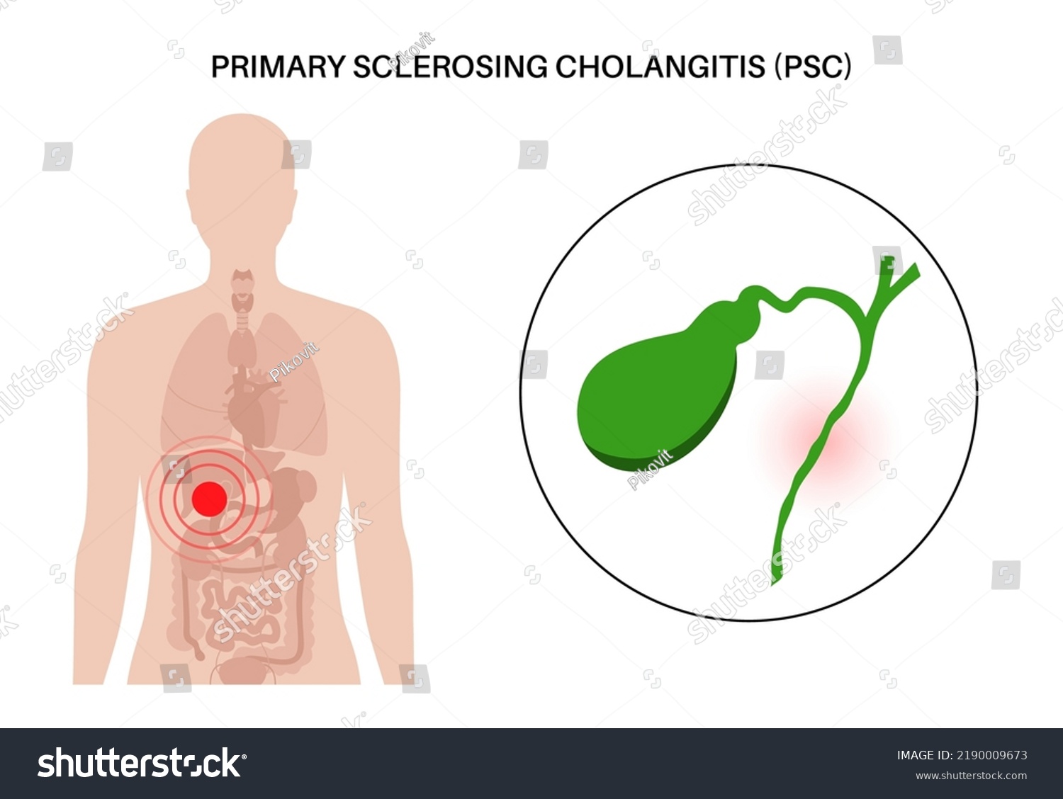 Primary Sclerosing Cholangitis Concept Psc Gallbladder Stock Vector