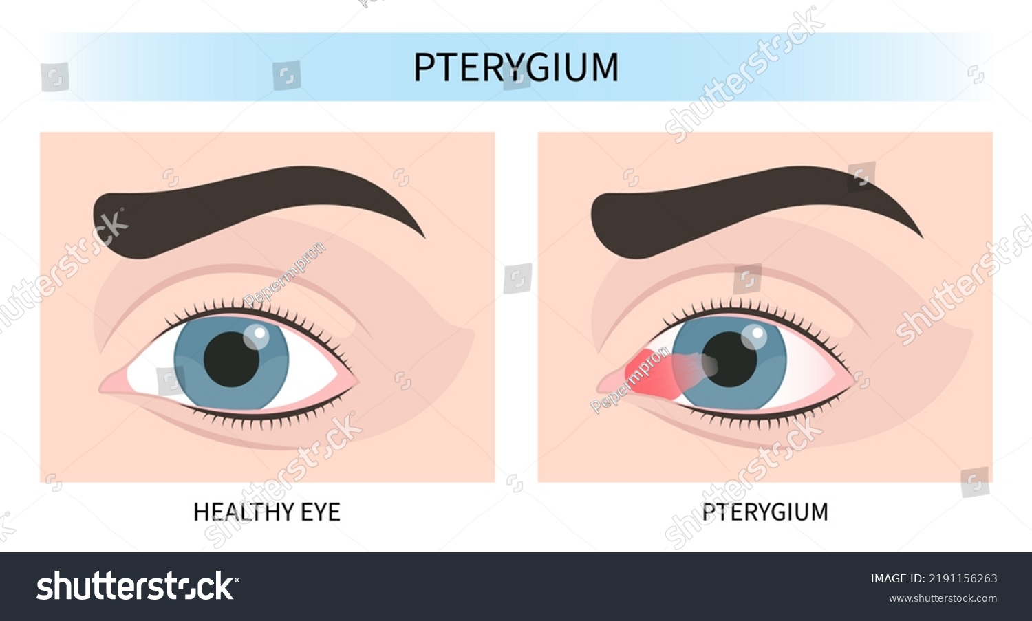 Pterygium Eye Disease That Causes Vision Stock Vector (Royalty Free ... Pterygium Eye Disease That Causes Vision Stock Vector (Royalty Free ...