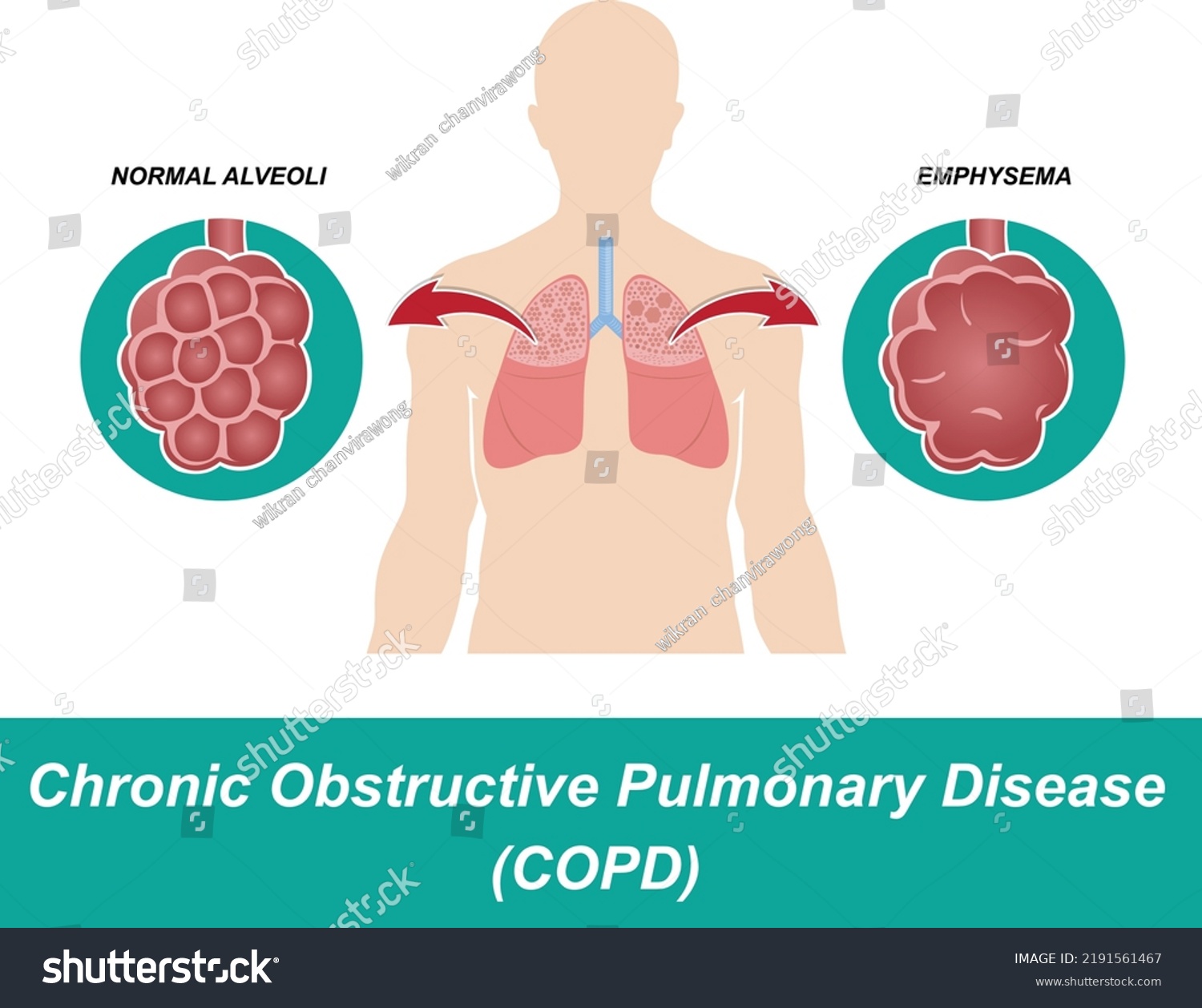Emphysema Icon Vector Illustration Designer Stock Vector (Royalty Free ... Emphysema Icon Vector Illustration Designer Stock Vector (Royalty Free ...